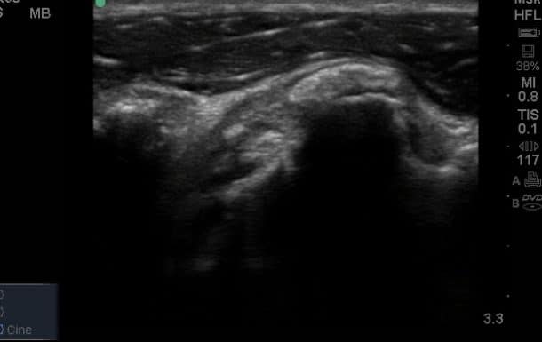 ← Partial thickness rotator cuff tear: A summary