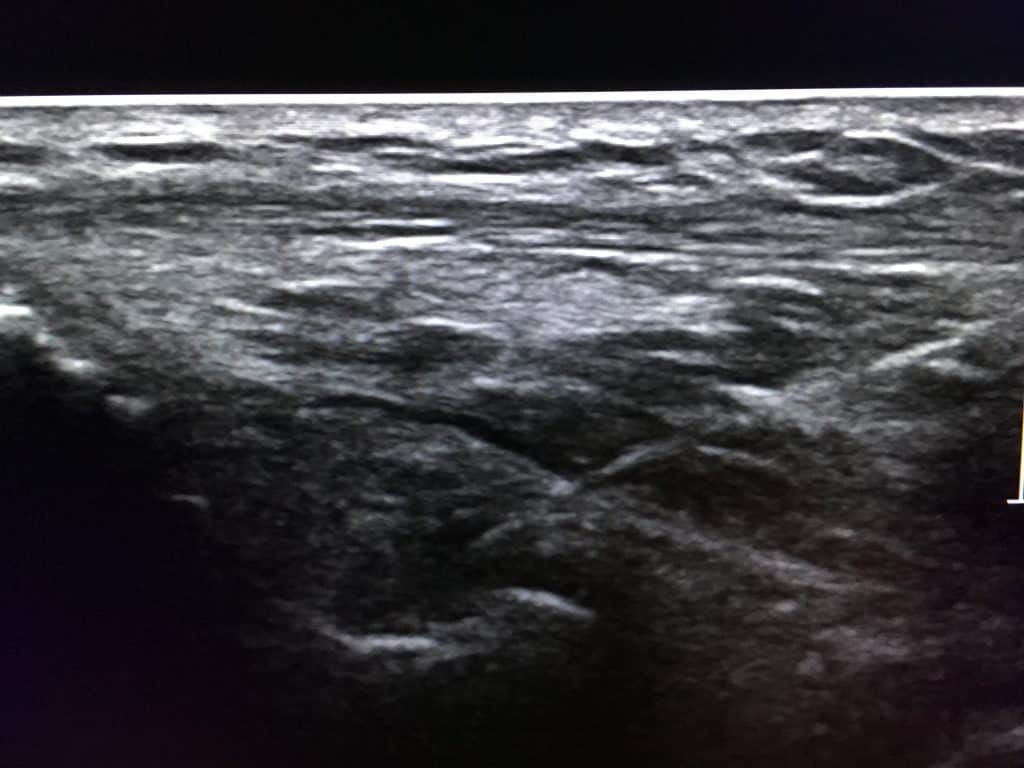 Posterior approach to injecting the elbow joint