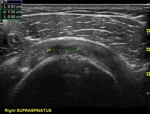 ← Greater tuberosity fracture Subscapularis calcification →