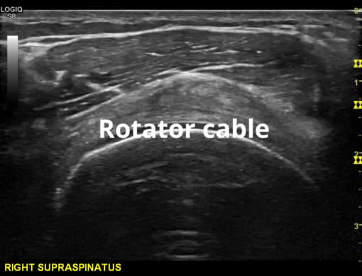 rotator cable