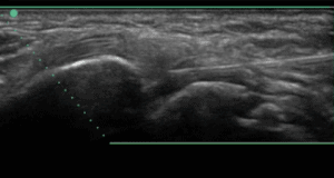 Ultrasound guided radiocarpal joint injection