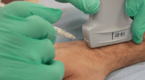 Ultrasound guided radiocarpal joint injection