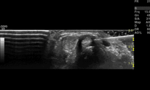 De quervains ultrasound guided injection technique