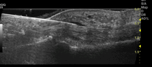 Ultrasound guided trigger finger / tenosynovitis injection