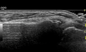 1st CMCJ ultrasound guided injection technique