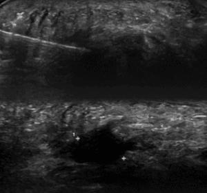 Mortons neuroma/bursal complex ultrasound guided injection - summary ...