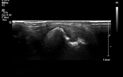 Erosions on ultrasound