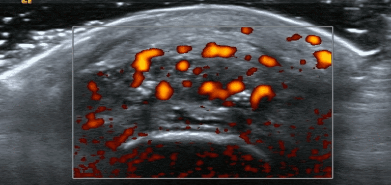 Erosions on ultrasound →