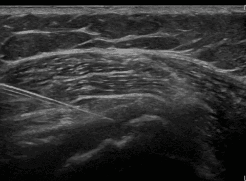 Cadogan et al (2013) Shoulder pain in primary care: diagnostic accuracy ...