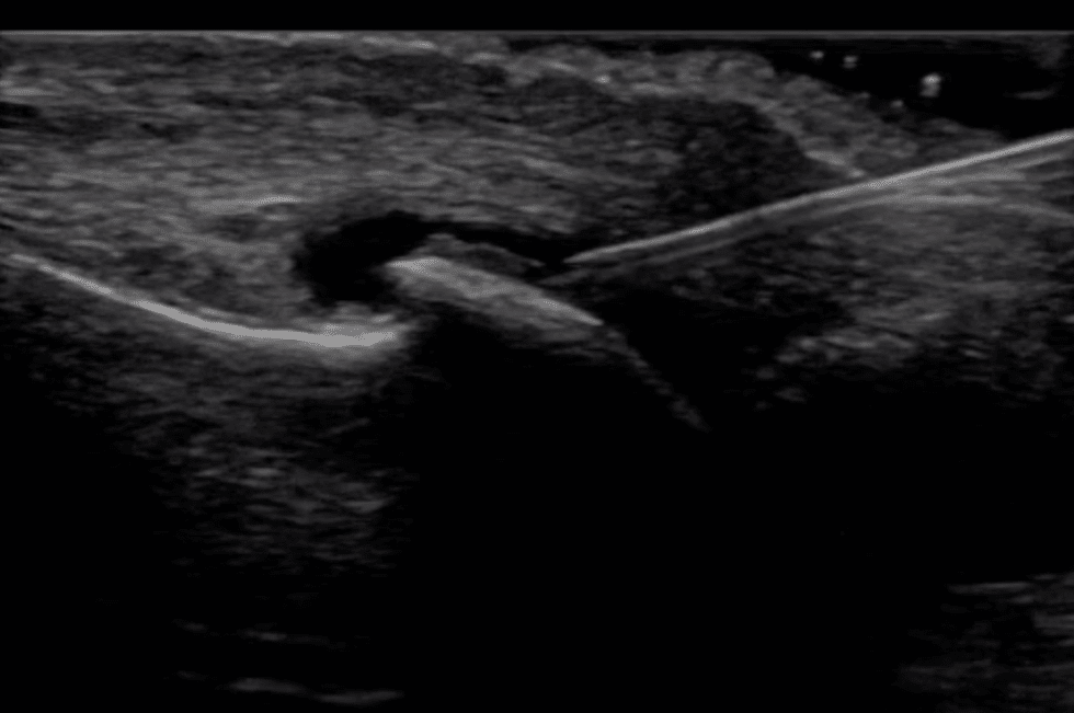 Anterior ankle ultrasound guided injection technique - summary sheet ...